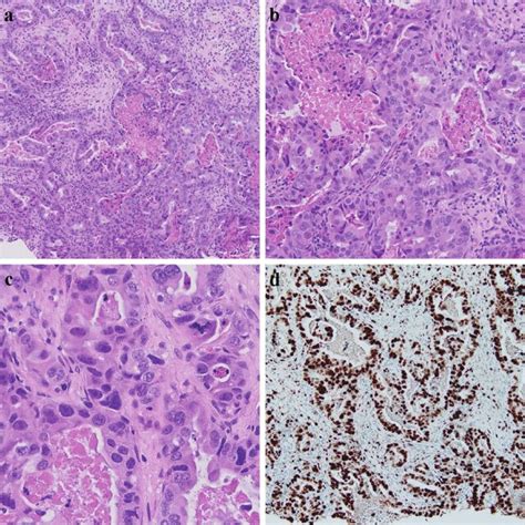 Left Breast Core Biopsy A × 10 B × 20 C × 40 Showing