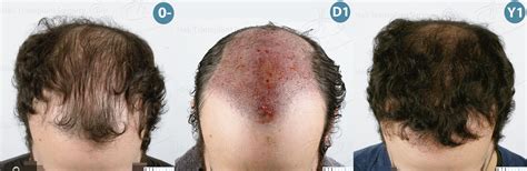 Dr Jean Devroye Hts Clinic 3920 Fut Frontal Area And Midscalp