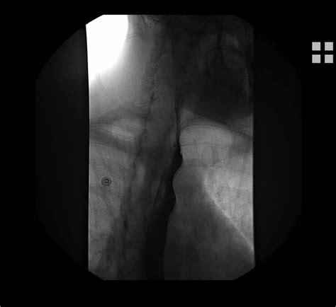 Barium Esophagram Demonstrating A Normal Esophagus Without Mucosal
