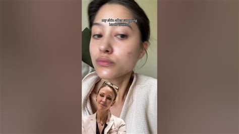 Incoming Derm Reaction Shorts Youtube