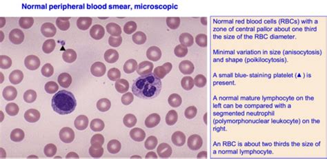 Session Hematopathology Flashcards Quizlet