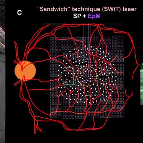 Configuration Of The Combined Laser Modalities A Sd Oct In Dsm Case Download Scientific
