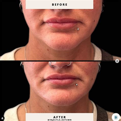 JuvÉderm® Voluma™ Xc Cheek Filler Dermablue