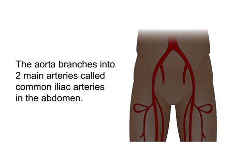 Abdominal Aortic Aneurysm Surgery