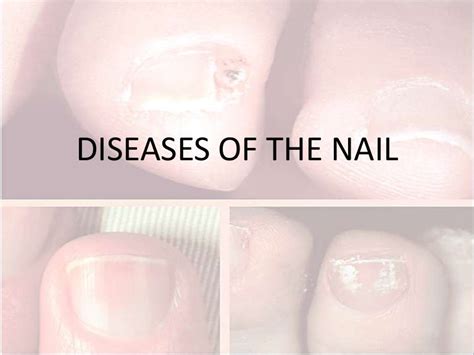 Dermatologynail Disorderdrmhamad Usif