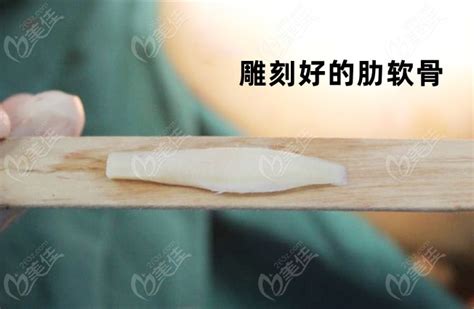 肋软骨隆鼻取的是哪个部位的软骨呢 看取肋骨做鼻子过程图来了解 最热整形行业新闻话题 美佳网