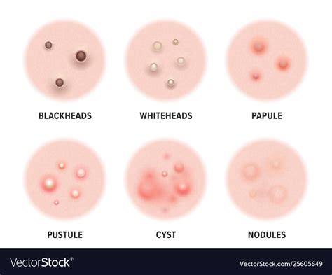 Skin Acne Types Diagram Disease Pimples Royalty Free Vector