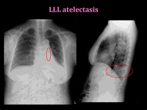 Atelectasis And Collapse In Cxr