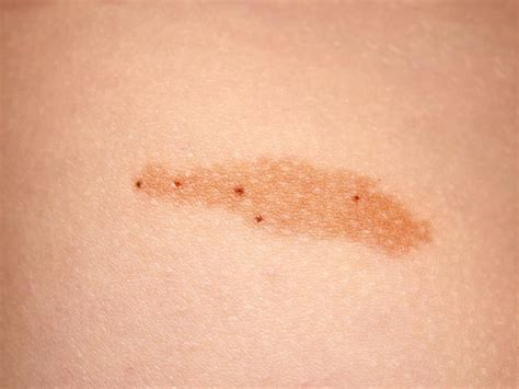 Birthmark On Thigh Meaning Right Left And Inner Thigh