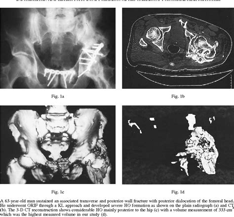 Kocher Debre Semelaigne Syndrome Semantic Scholar