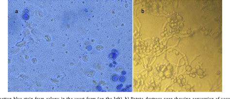 Figure 5 From A Rare Case Of Blastomyces Dermatitidis Brain Abscess In