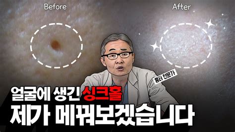 얼굴에 생긴 구멍에 화장품이 계속 낀다면 Youtube