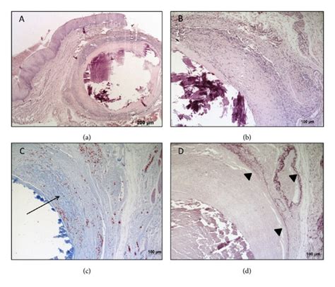 An Isolated Phlebolith On The Lip An Unusual Case And Review Of The Literature Gouvêa Lima