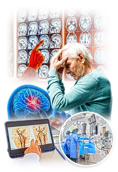 เช็คอัพ อาการเสี่ยง “โรคหลอดเลือดสมองโป่งพองแตก”