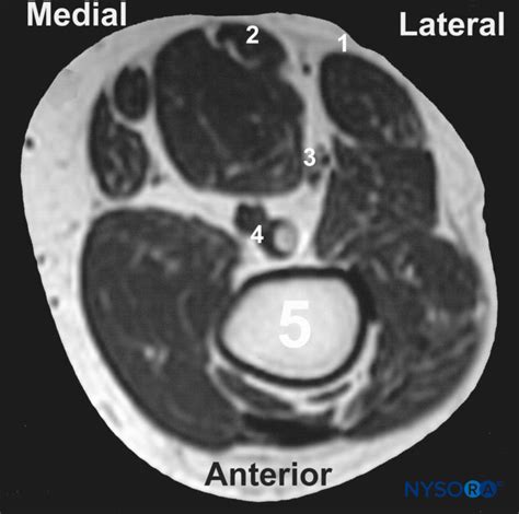 Popliteal Sciatic Nerve Block Landmarks And Nerve Stimulator
