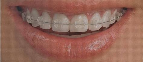 17 Mejores Brackets De Plásticos Transparentes Y