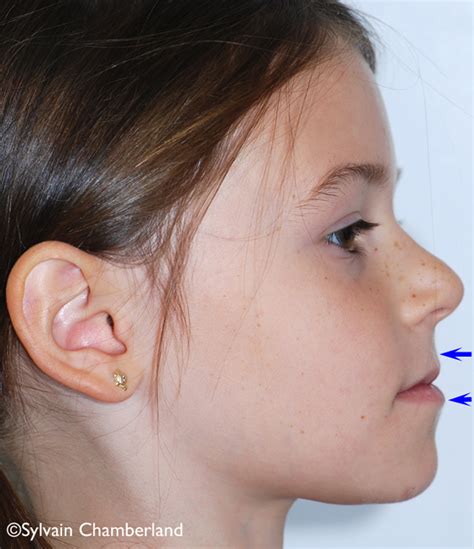 Protraction Facemask Dr Sylvain Chamberland Orthodontist