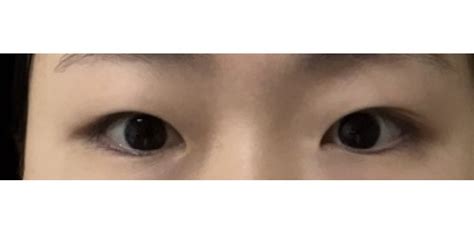 리얼후기 16 페이지 눈이 예쁘다 그래서 아몬드성형외과