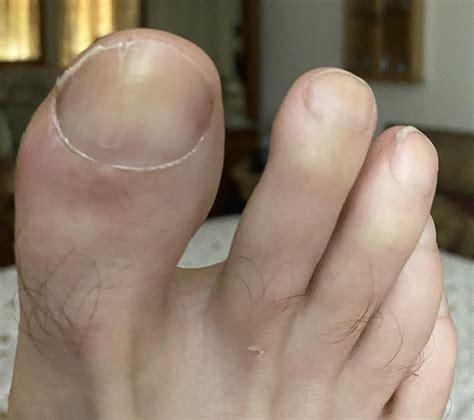 Big Toenail Its Impossible For Me To Have An Ingrown Toenail R