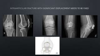 Fractures Around Knee Pptx