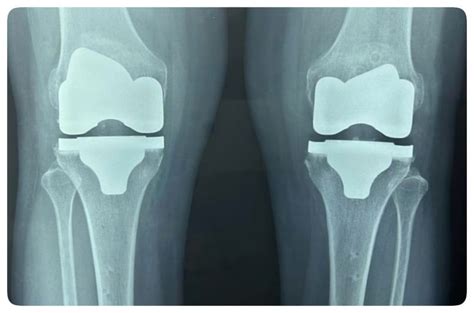 Get Your Total Knee Replacement Surgery Dr Narayan Hulse