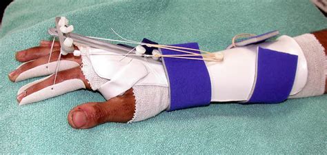 Extensor Tendon Therapy Guidelines Zones Iii Iv Hand Surgery Resource
