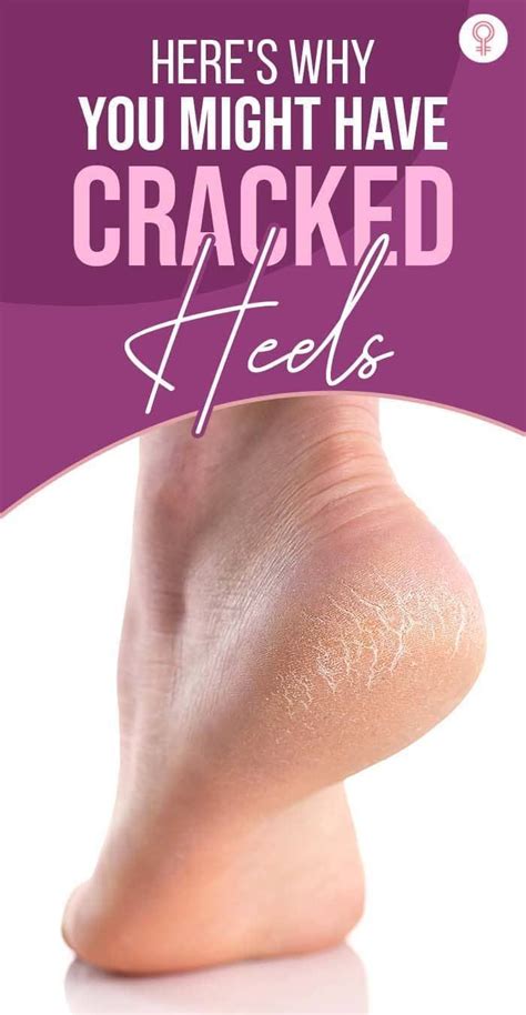 What Causes Cracked Heels Artofit