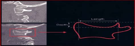 Craniovertebral Junction Abnormalities In Down Syndrome Neurosurgery