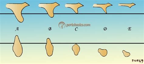 Bone Considerations In Dental Implant Therapy