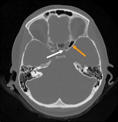 Anterior Clinoid Process Anterior Clinoid Process E Anatomy Imaios