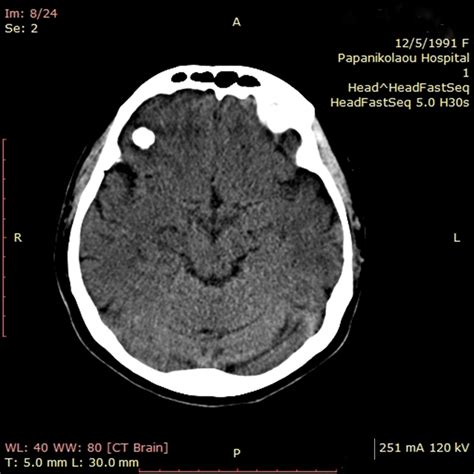 Axial Brain Ct Scan Depicting A Bone Density Mass In The Right Frontal