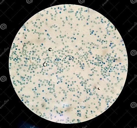 Microscopic Image Of Abnormal High Reticulocytes Count Nucleated Rbc Or Nrbc Test At Medical