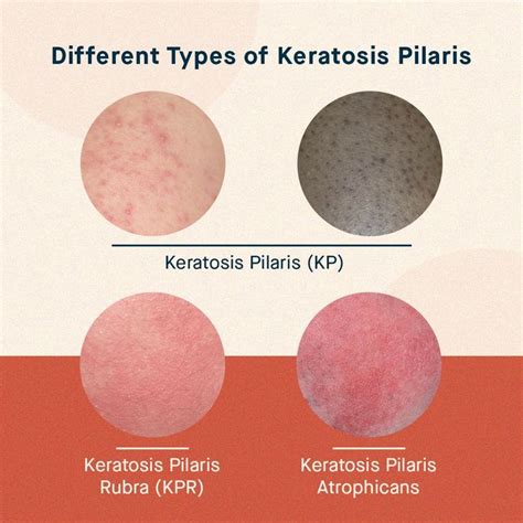 Curious About Keratosis Pilaris Or Think You May Have It Learn More