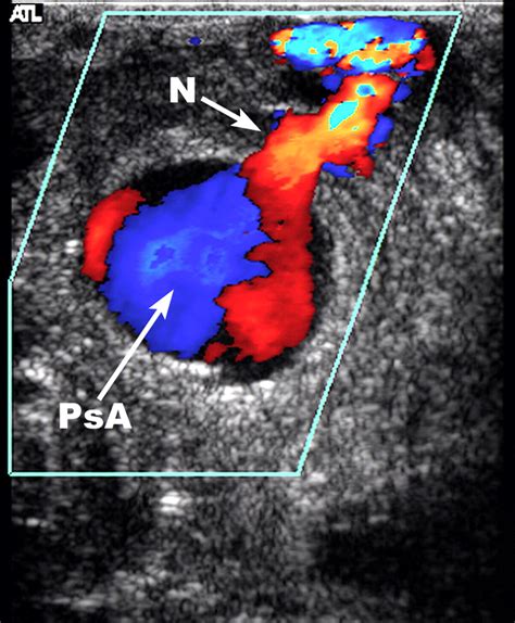 Pseudoaneurysms And The Role Of Minimally Invasive Techniques In Their