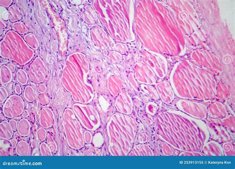 Fibrous Thyroiditis Light Micrograph Stock Image