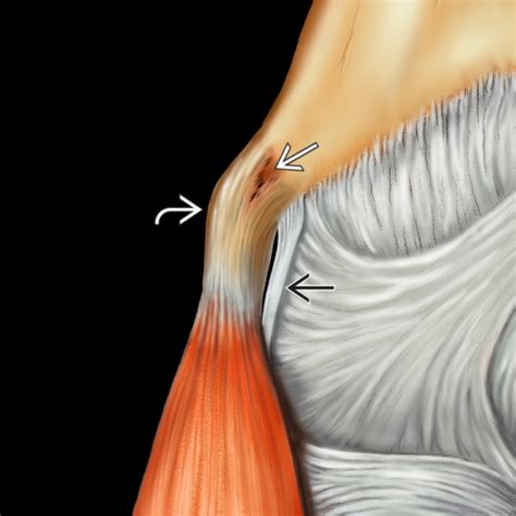 Elbow Epicondylitis Radiology Key