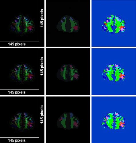Segmentation Of Brain Mri Image Second Third And Fourth Column Download Scientific Diagram