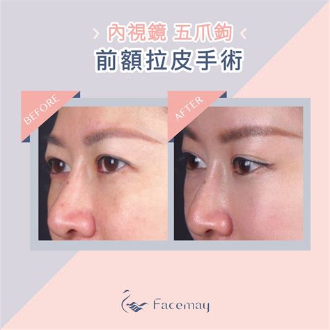 菲仕美整形外科診所 眼睛下垂了嗎？ 以為是雙眼皮不夠深但其實是臉皮鬆了喔！ 👉內視鏡五爪鉤
