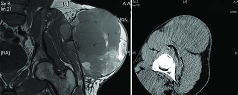 A Magnetic Resonance Imaging And B Computed Tomography Of A Left