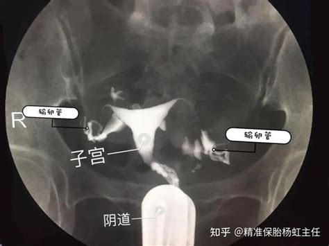 你的输卵管咋样？2分钟教你看懂输卵管造影片子！ 知乎