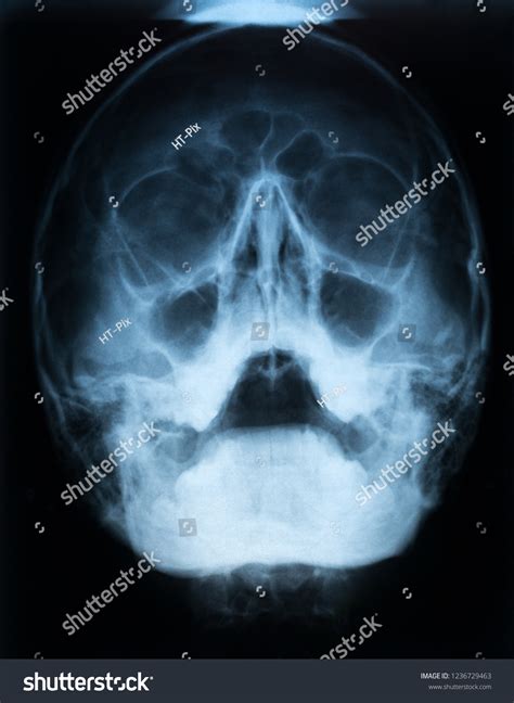 Maxillary Sinus X Ray Film X Ray Paranasal Sinus Show Sinusitis Stock