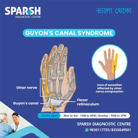 Guyons Canal Syndrome Causes Symptoms Diagnosis And Treatment