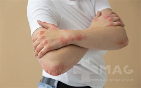 بیماری زونا چیست؟