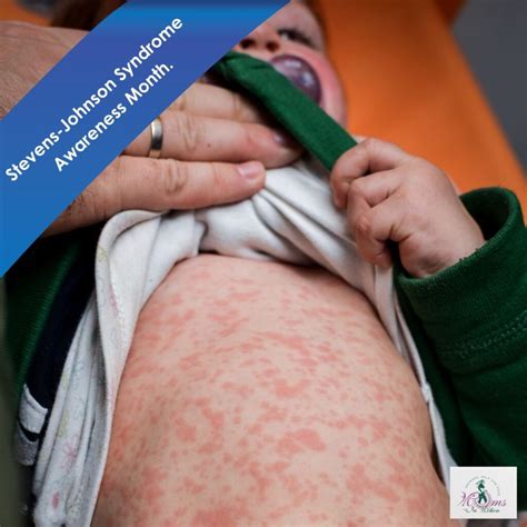 August Is Stevens Johnson Syndrome Awareness Month Moms In Motion