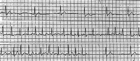 Sick Sinus Syndrome Causes Symptoms Ecg Treatment