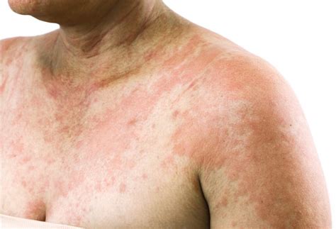 Symptoms And Treatment Of A Banana Allergy