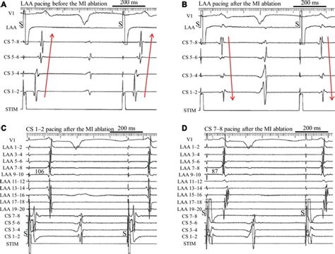 Mitral Isthmus Ablation Circulation Arrhythmia And Electrophysiology