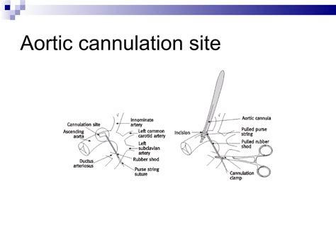 Cannulation Techniques During Cpb Ppt