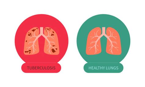 Best Tuberculosis Illustrations Royalty Free Vector Graphics And Clip
