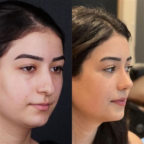 Rhinoplasty In Turkey • Dr Selim Turan